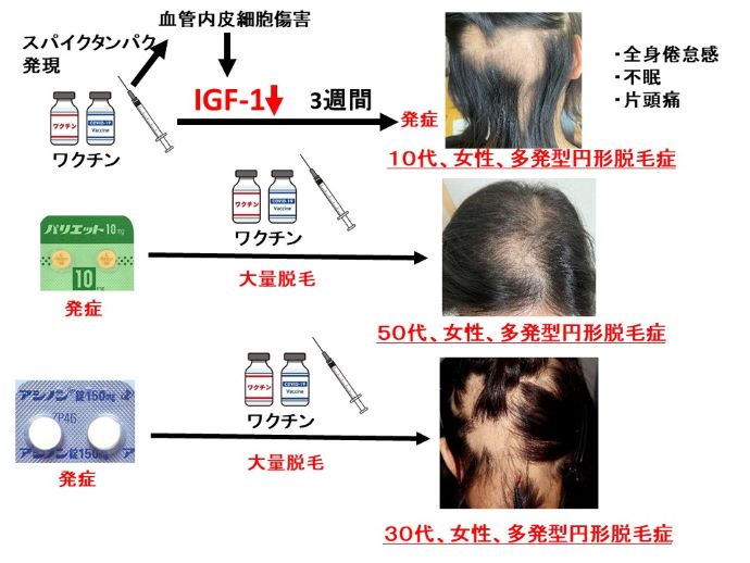 新型コロナワクチンで円形脱毛症が発症・悪化！打たないようにしましょう。特に3回目以降でリスク大です！！！ 患者様からの声・メディア掲載